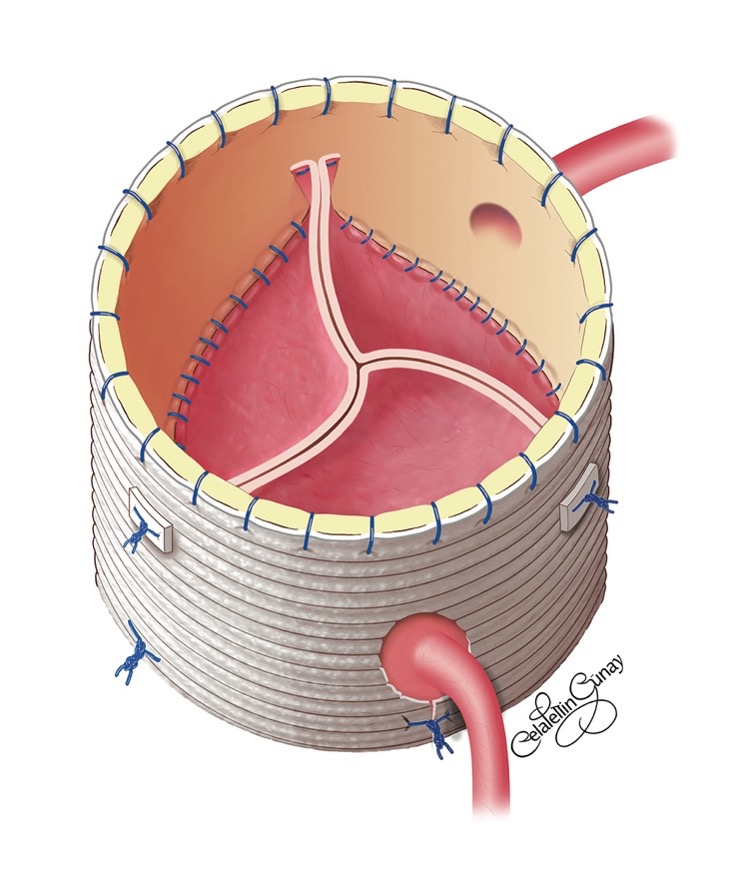 A new alternative to the Bentall procedure: aortic valve neocuspidization (Ozaki procedure) with ...
