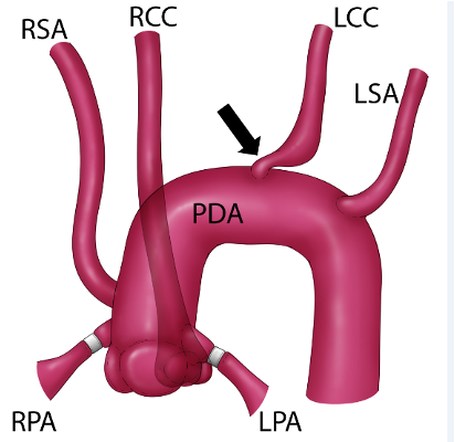 Yasui procedure for an interrupted aortic arch type C with an aberrant ...