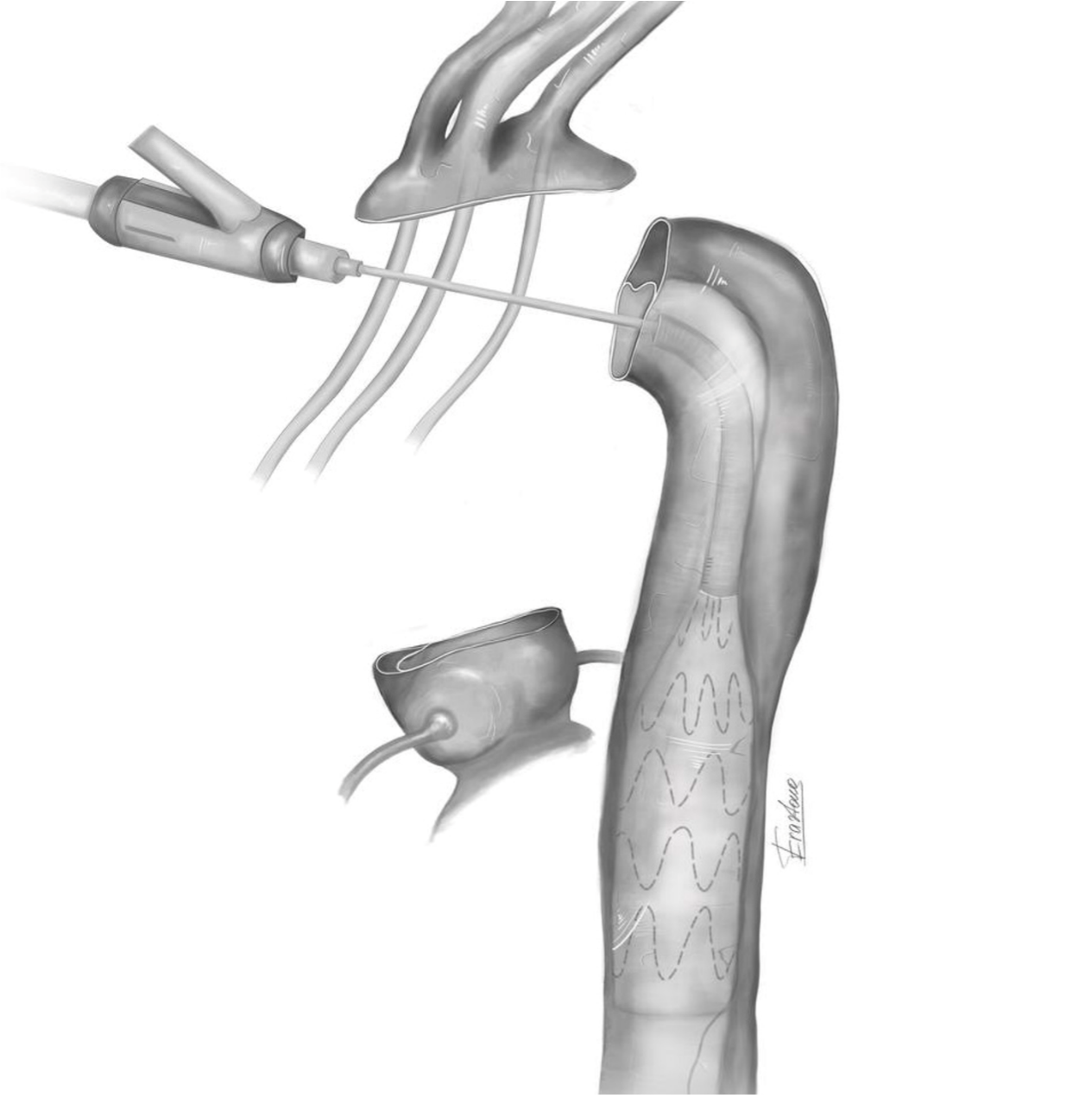 Aortic valve resuspension using the Florida sleeve technique with ...
